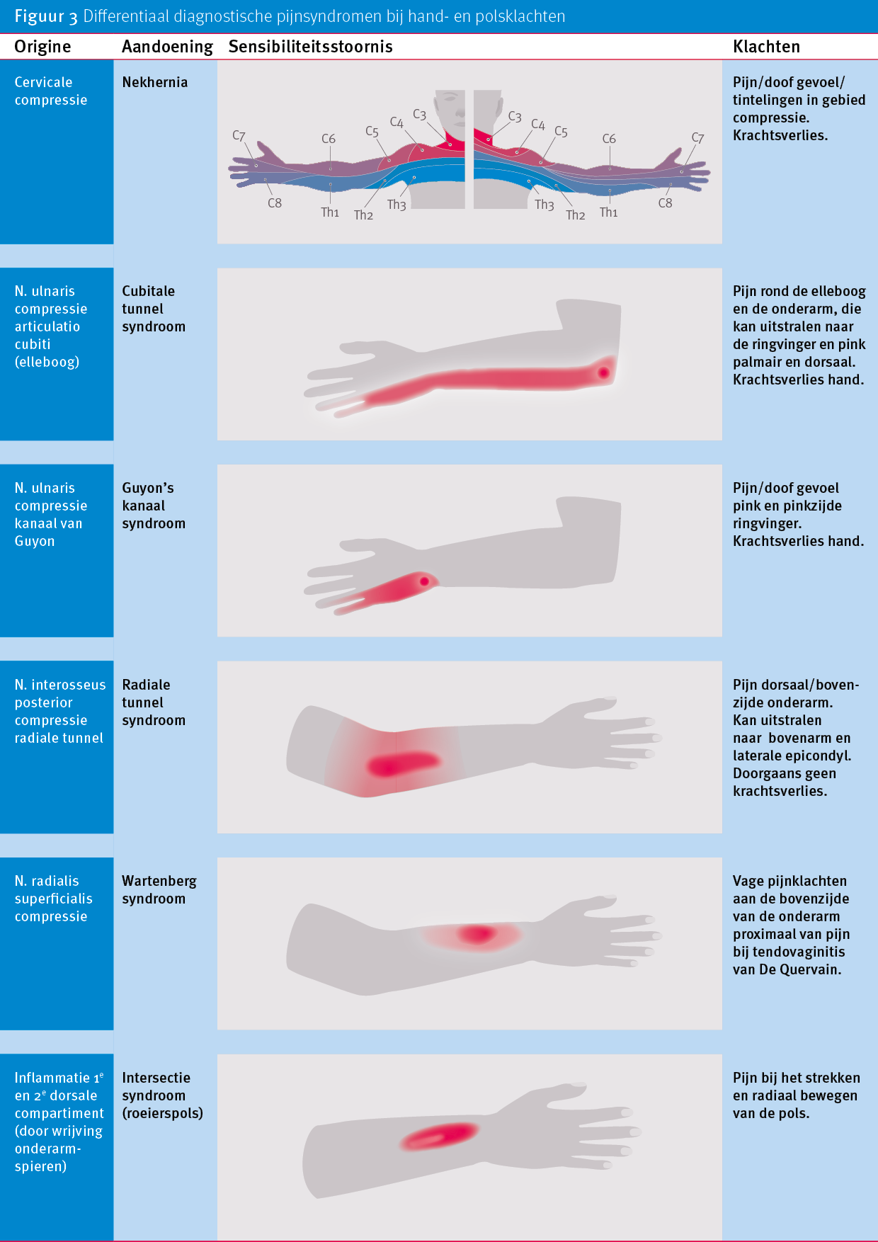 Hand- en polsklachten | NHG-Richtlijnen